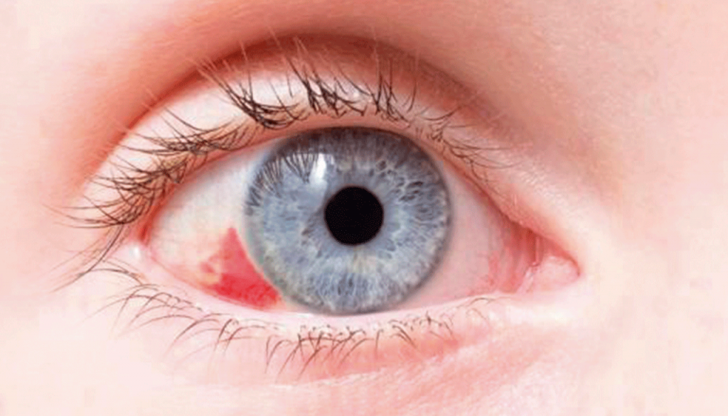 Quais são as causas e o tratamento para o derrame ocular? | Lentes e ...